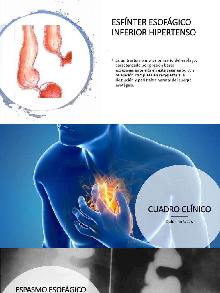 Esfínter Esofágico Inferior Hipertenso | PDF