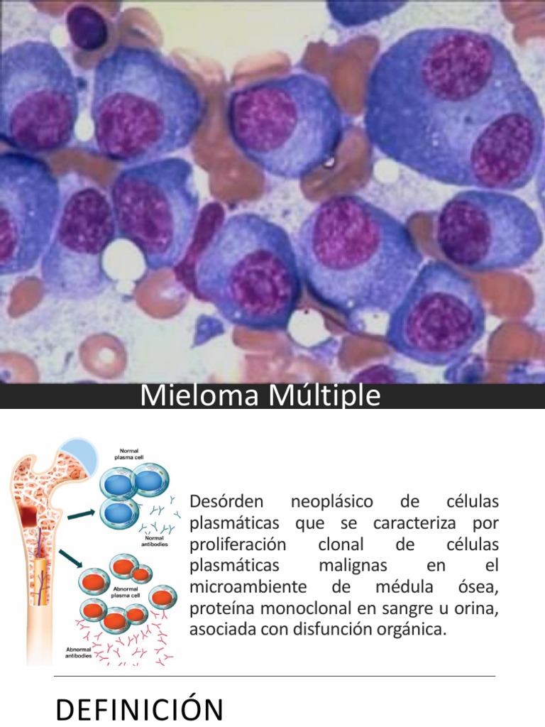 Guía Completa sobre Mieloma Múltiple | PDF | Mieloma múltiple ...