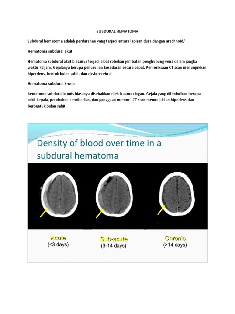 Subdural Hematoma | PDF