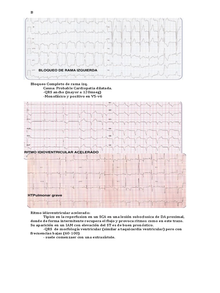 Ejemplos de Electrocardiogramas.