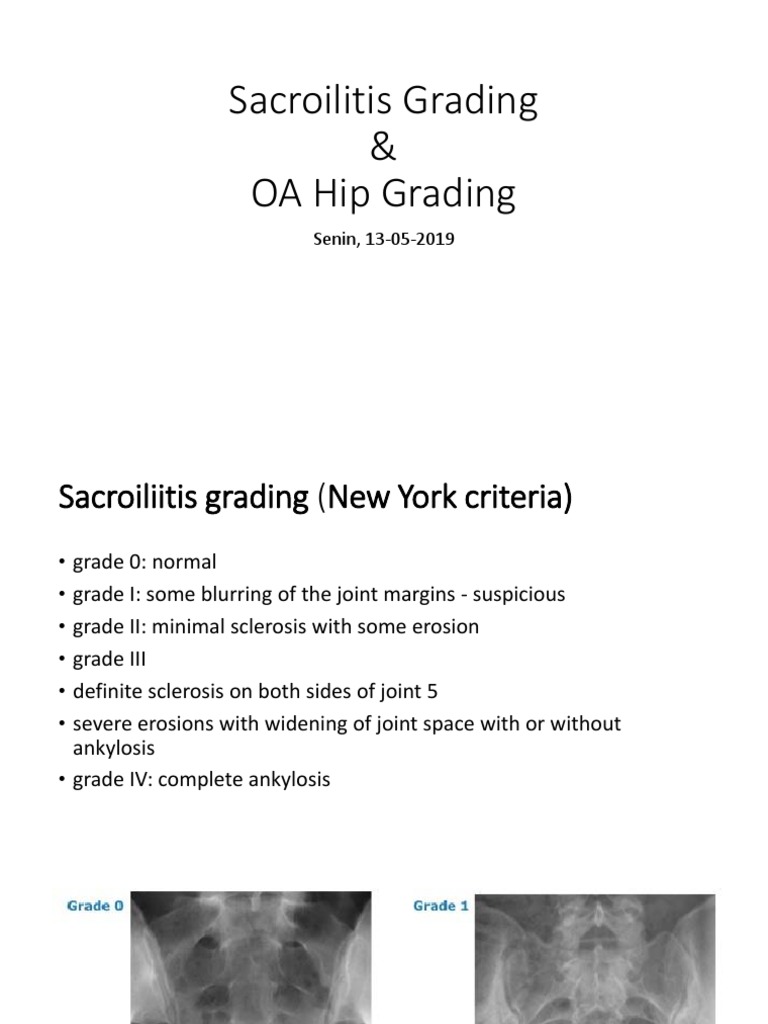 Sacroilitis Grading | PDF | Arthritis | Musculoskeletal System