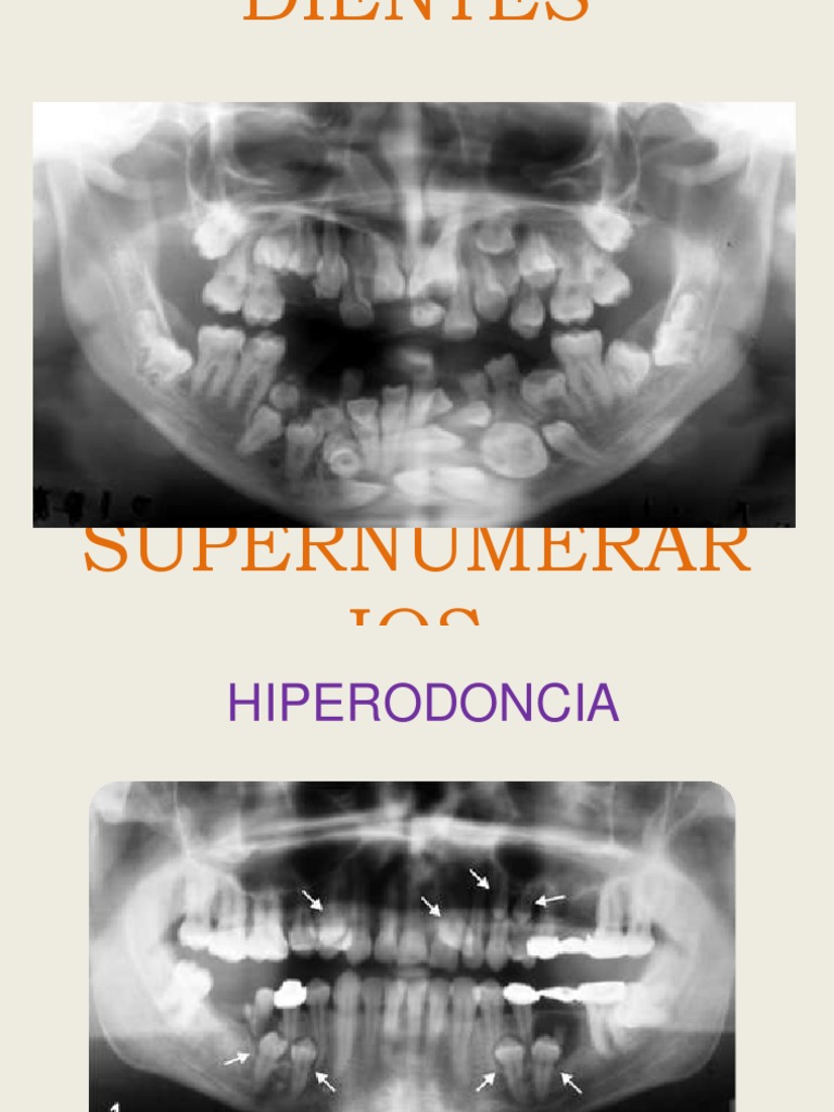 Dientes Supernumerarios: Epidemiología y Tratamiento | PDF | Diente ...