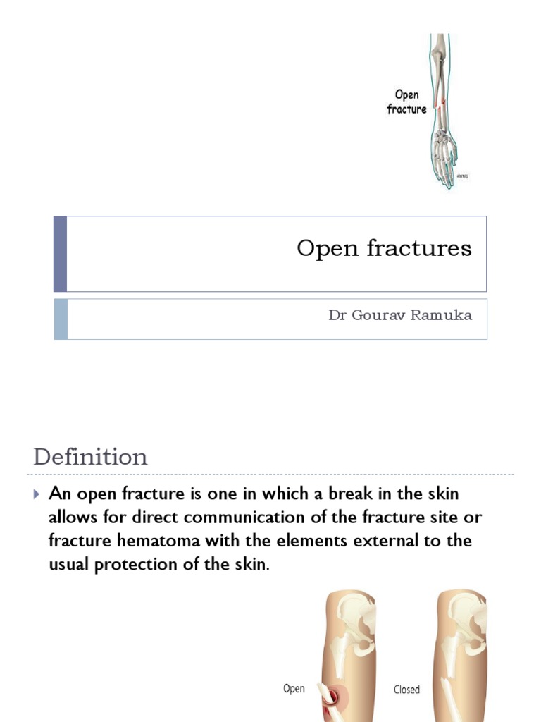 Open Fractures: DR Gourav Ramuka | PDF | Wound | Epidemiology