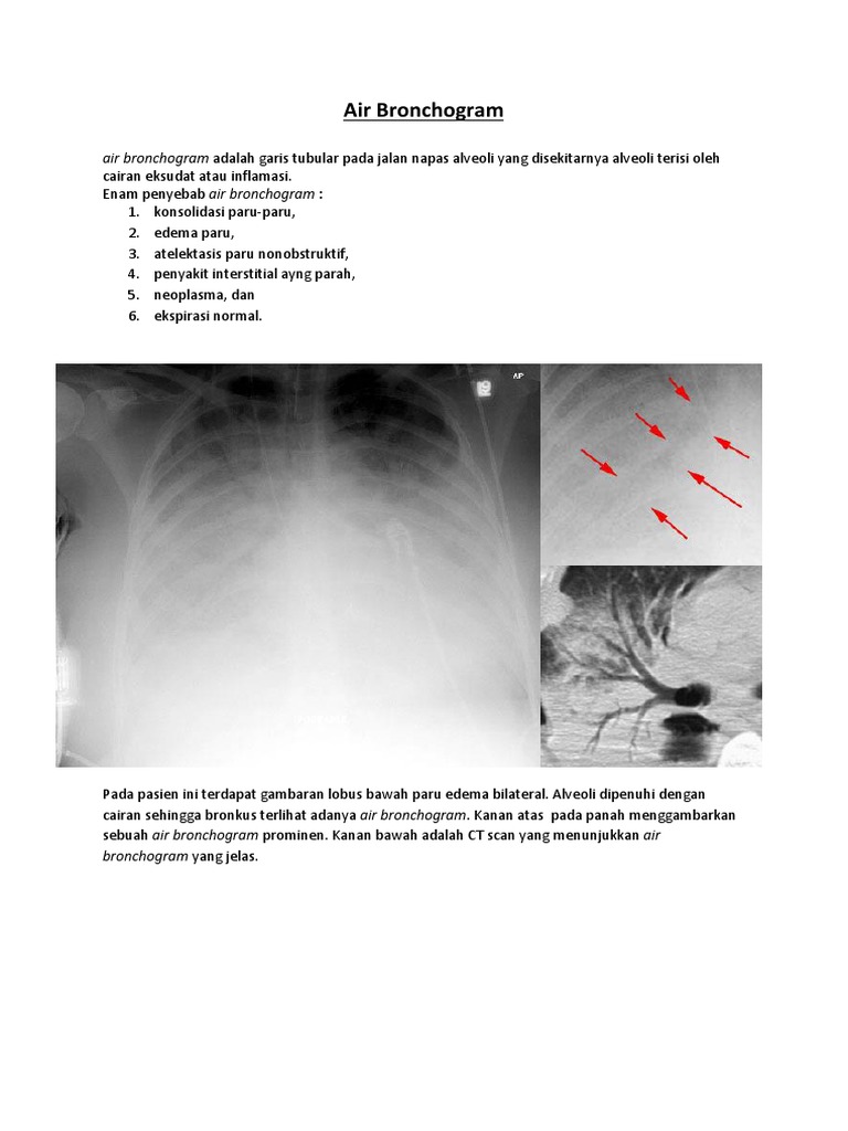 Air Bronchogram | PDF