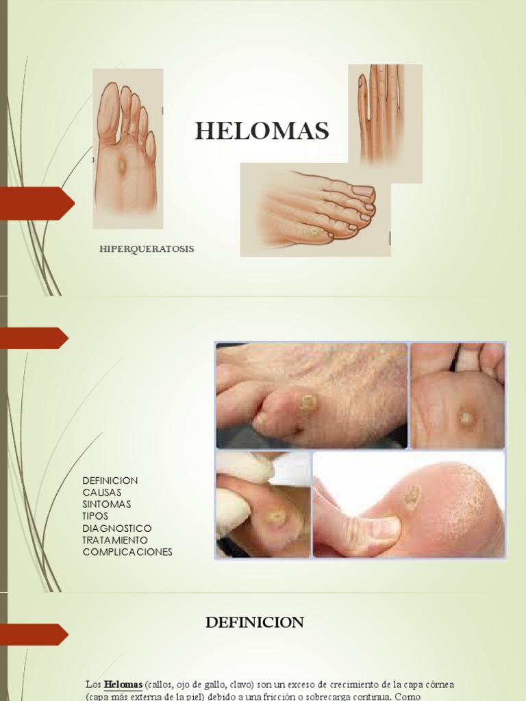 Tipos de Helomas y Tratamientos | PDF | Dedo del pie | Pie