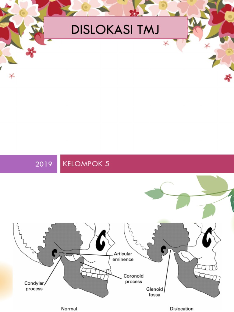 Dislokasi TMJ | PDF