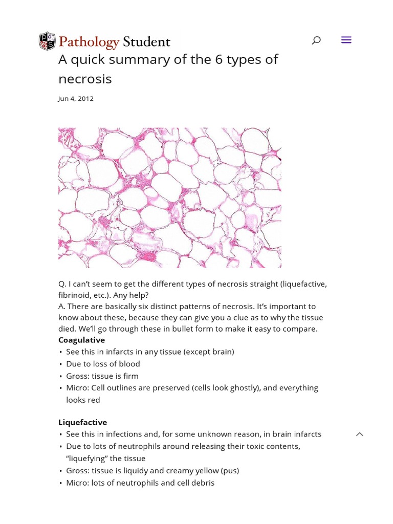 A Quick Summary of The 6 Types of Necrosis | PDF | Necrosis | Macrophage