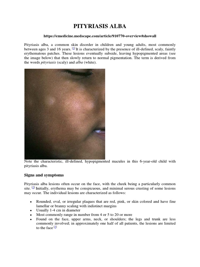 Pityriasis Alba