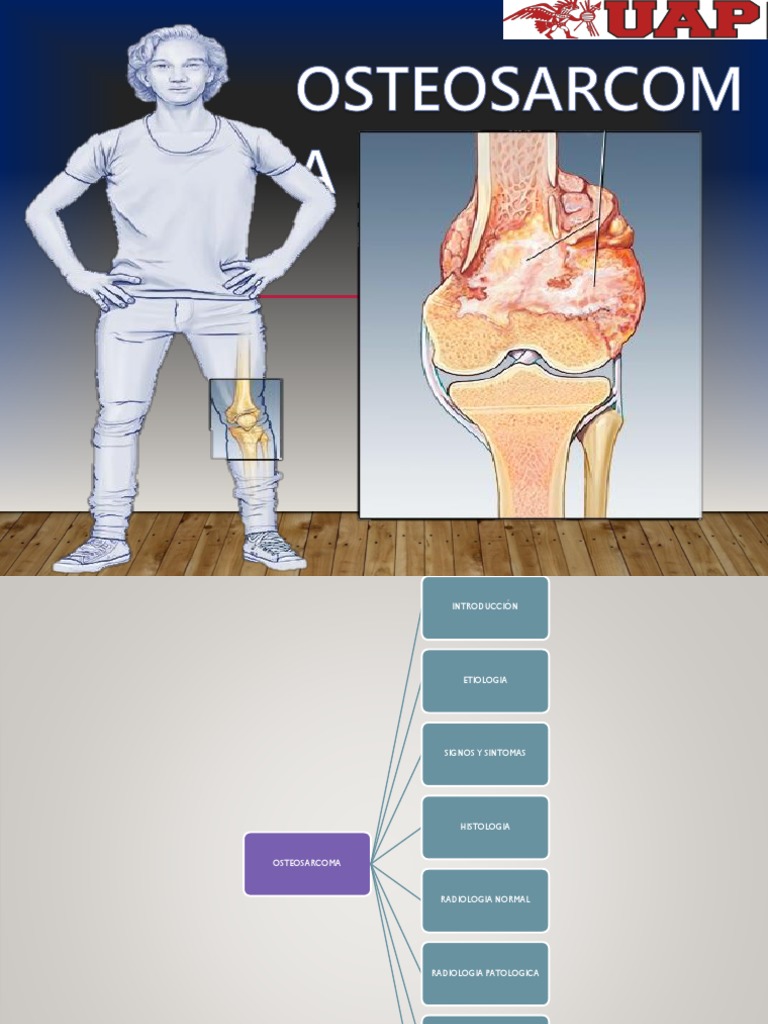 Osteosarcoma | PDF