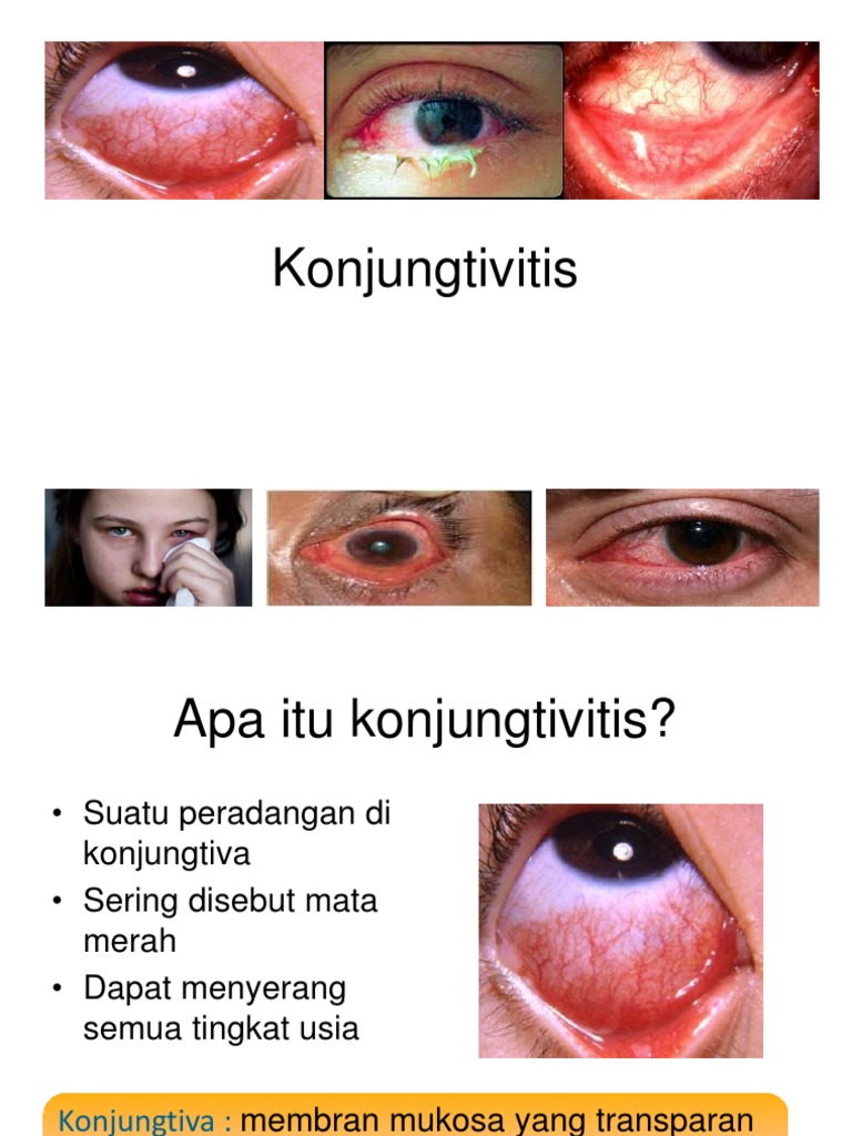 Jenis dan Penyebab Konjungtivitis | PDF