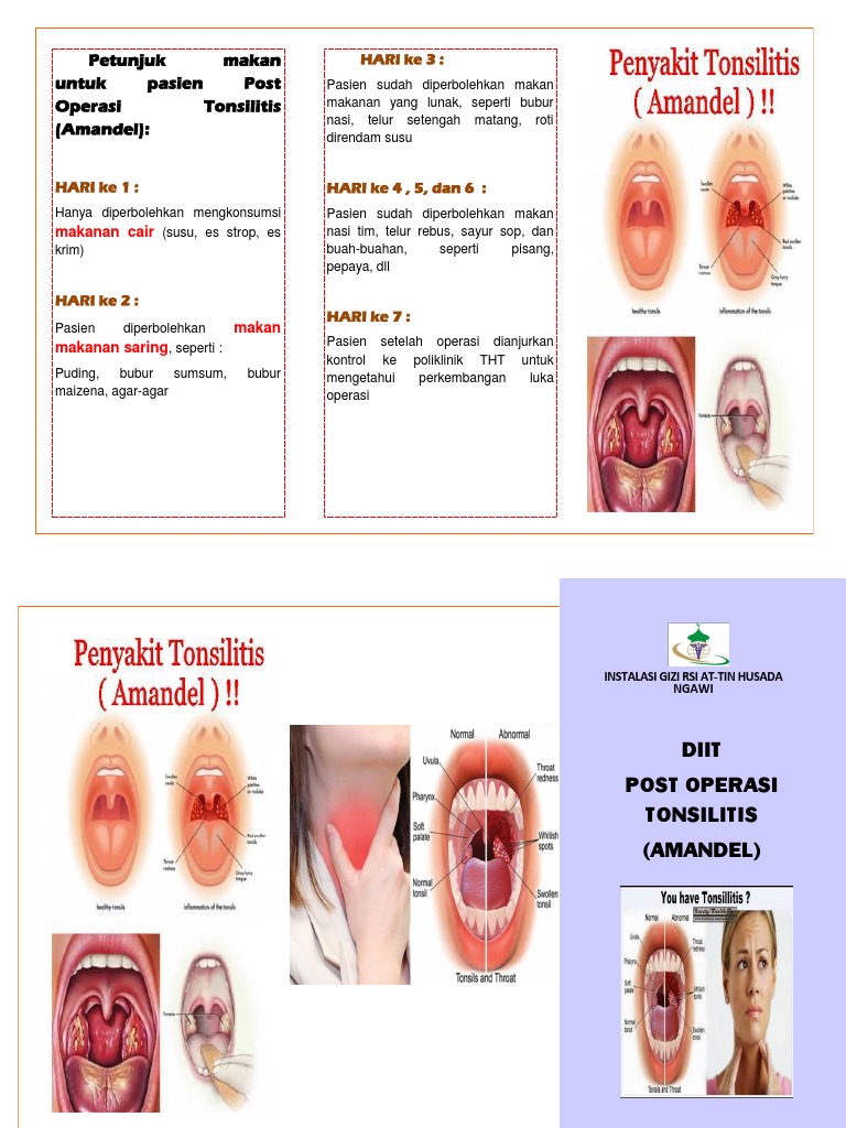 Post OP Tonsilitis | PDF