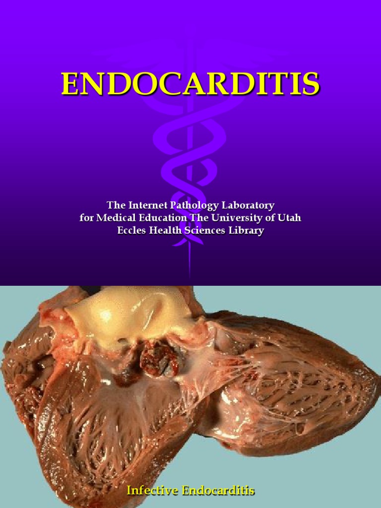 Endocarditis | Heart Valve | Internal Medicine | Free 30-day Trial | Scribd