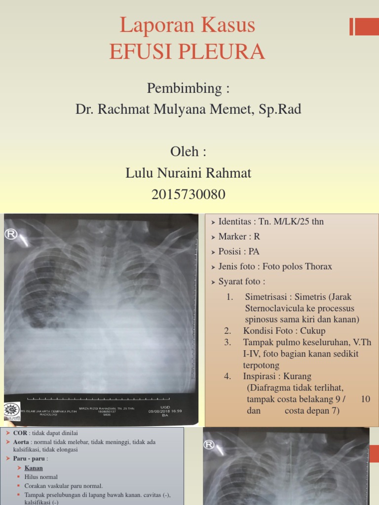 Lapkas 1 Efusi Pleura | PDF | Seni