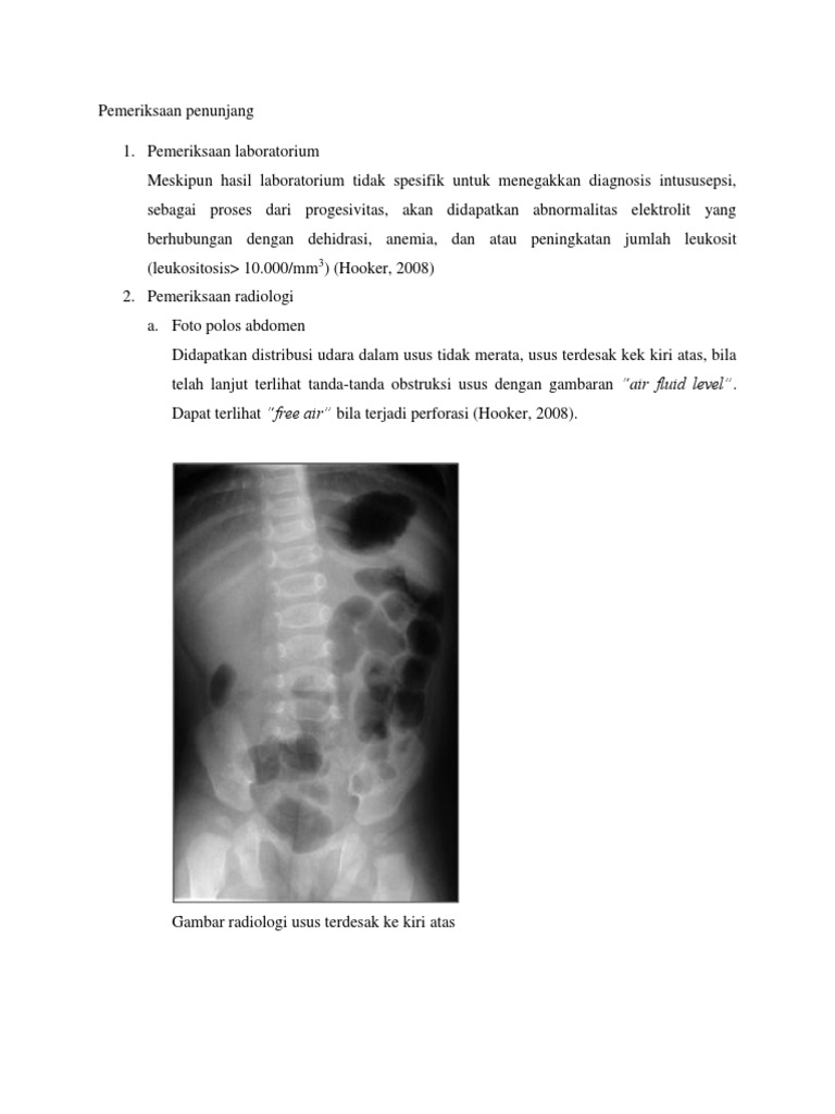 Evaluasi Radiologi Intususepsi Anak | PDF | Ilmu Sosial | Kesehatan ...