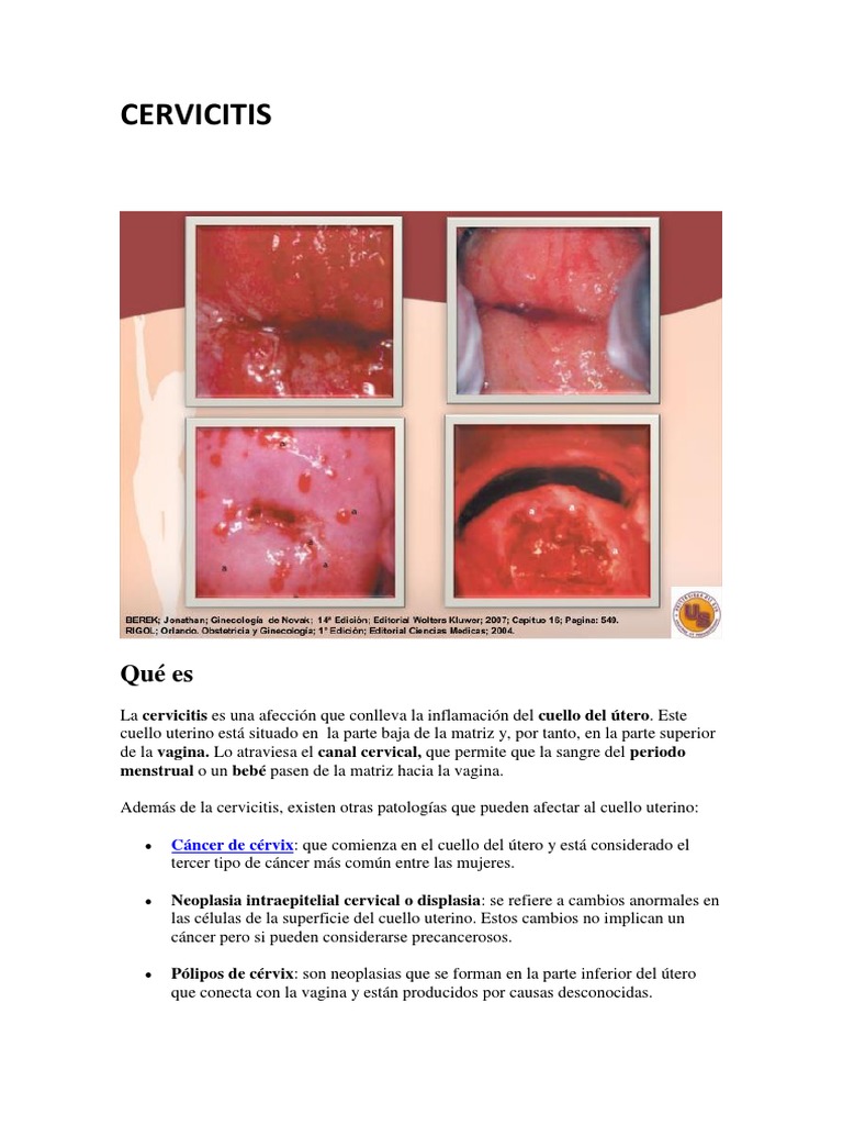 Cervicitis: causas, síntomas, diagnóstico, tratamiento y prevención de ...