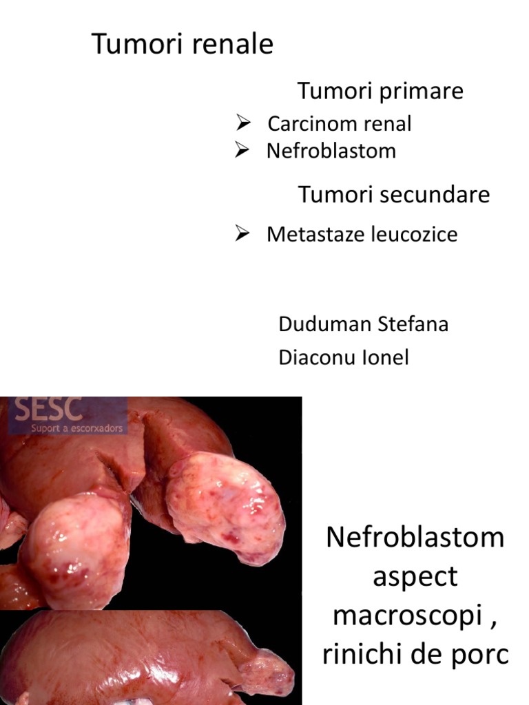 Tumori Renale 1 | PDF