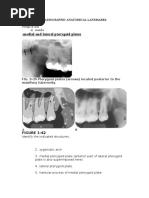 Pterygoid Plate Radiograph