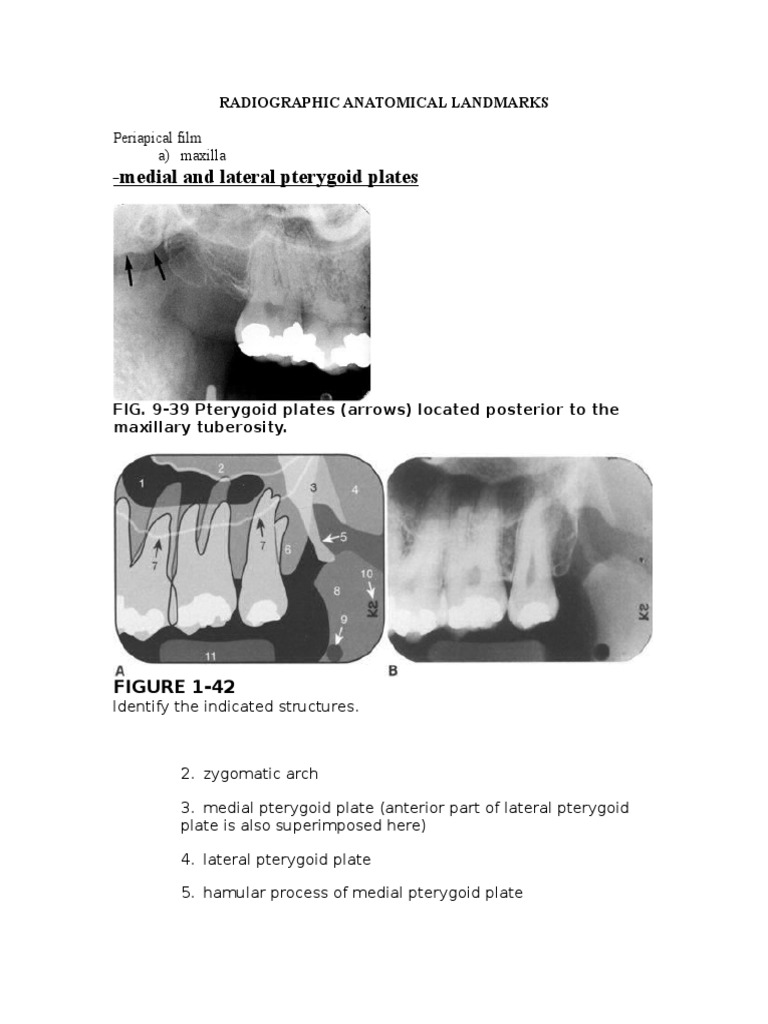 Medial and Lateral Pterygoid Plates: Periapical Film A) Maxilla | PDF ...