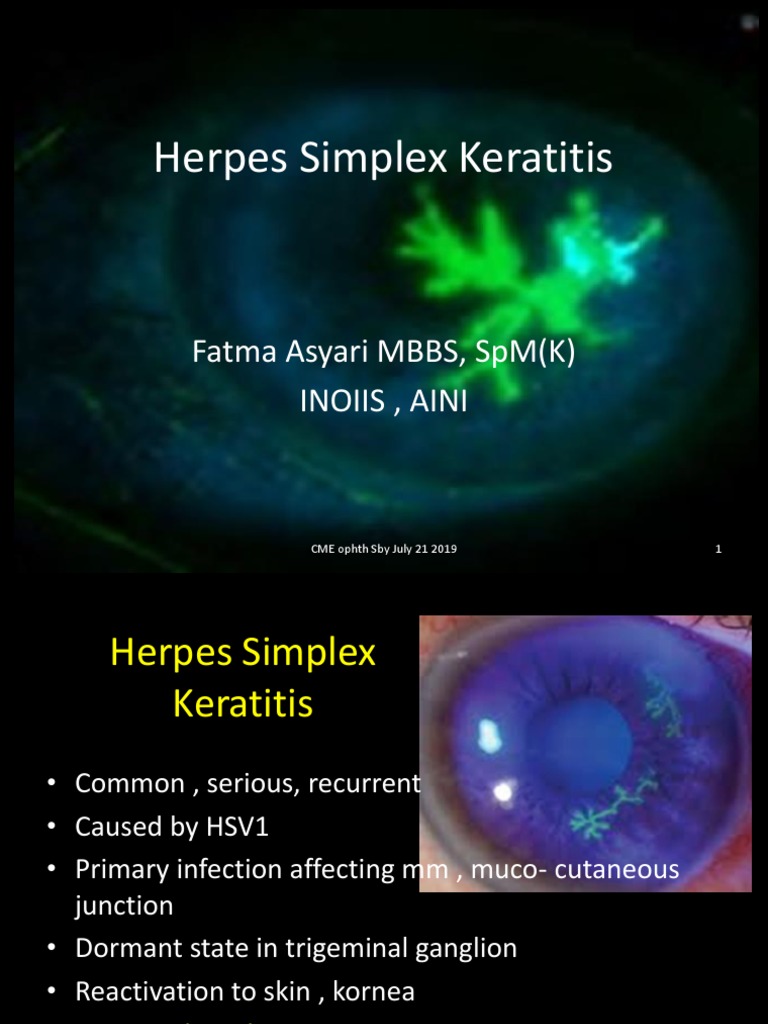 Herpes Simplex Keratitis | PDF | Viral Diseases | Health Sciences