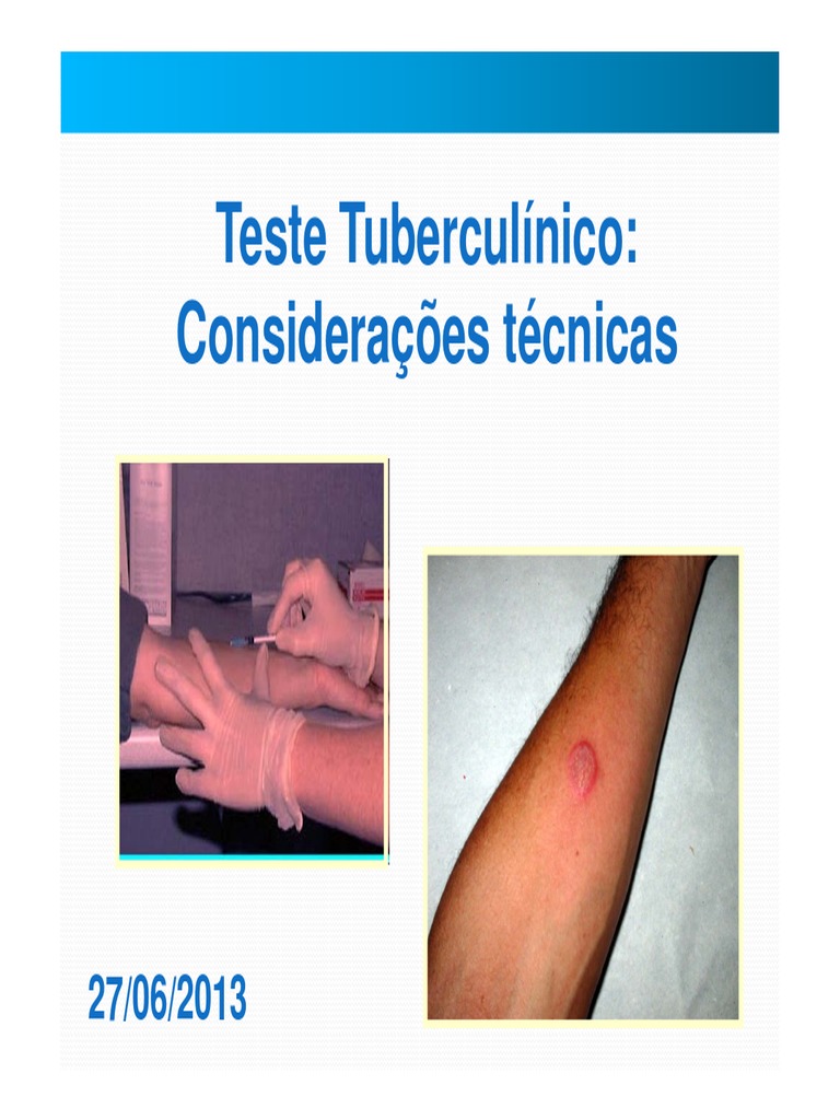 Prova Tuberculínica Tipo PPD 2013 | PDF | Tuberculose | Febre