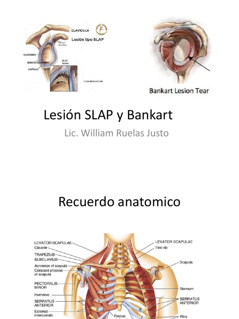 Lesiones SLAP y Bankart en el Hombro | PDF | Hombro | Extremidades ...