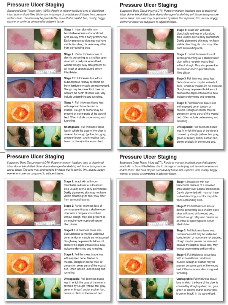 Pressure Ulcer Staging Card | Skin | Wound
