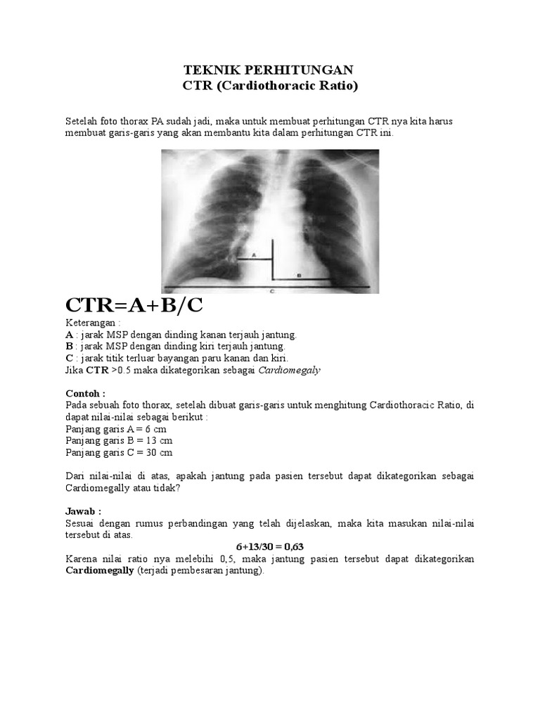 CTR A+B/C: Teknik Perhitungan CTR (Cardiothoracic Ratio) | PDF | Metode & Bahan Ajar