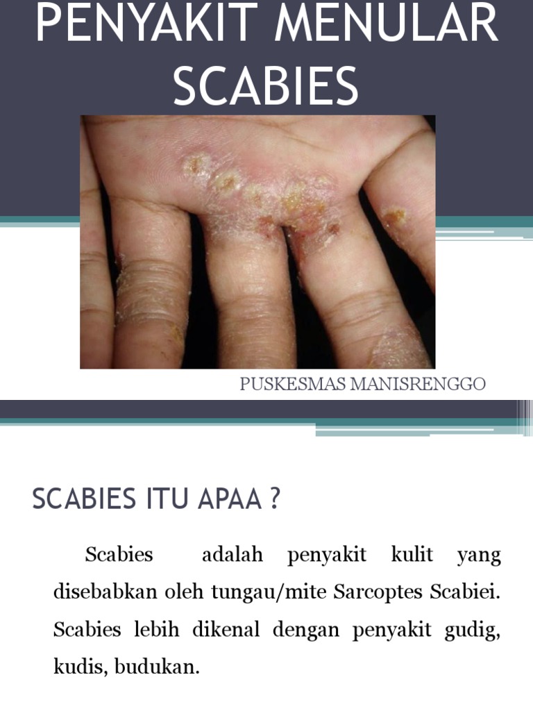 Penyakit Menular Scabies | PDF