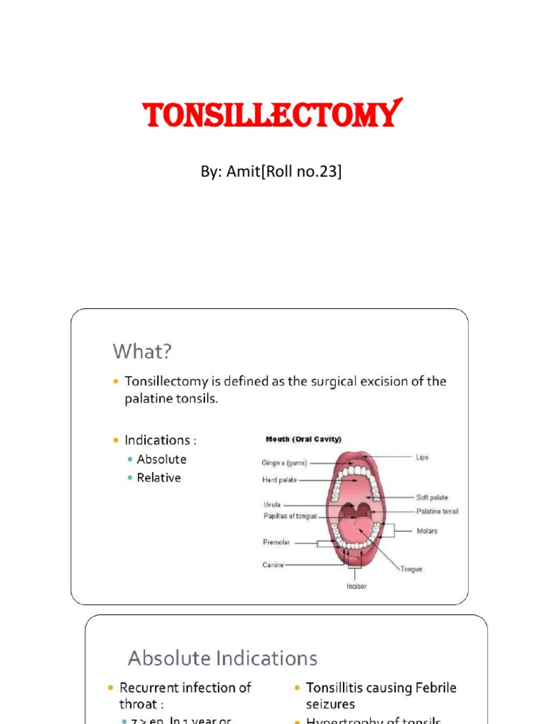 Tonsillectomy | PDF
