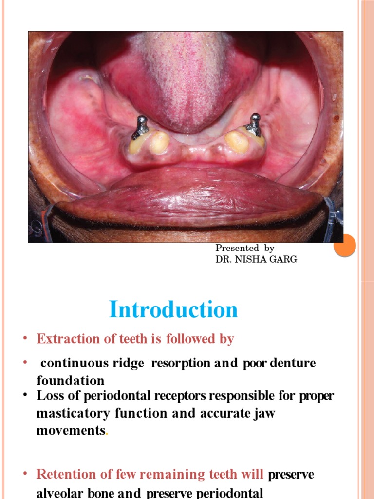 Seminar Overdenture | Human Tooth | Mouth