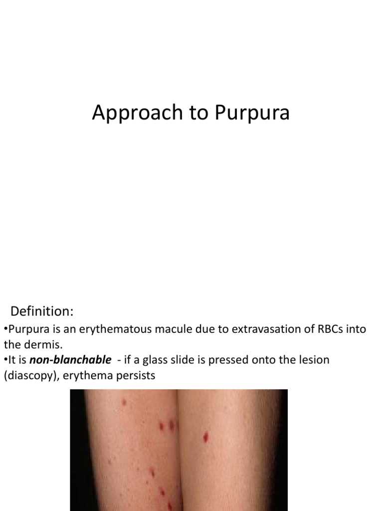 Approach To Purpura | PDF | Coagulation | Platelet