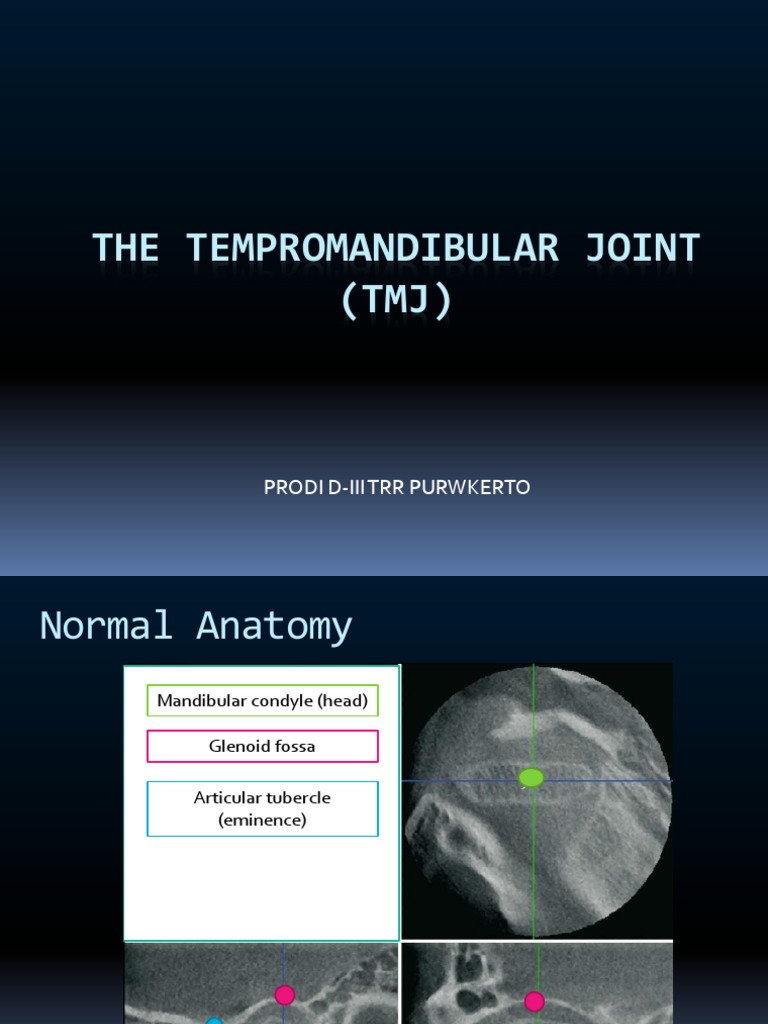 The Tempromandibular Joint (TMJ) : Prodi D-Iii TRR Purwkerto | PDF ...
