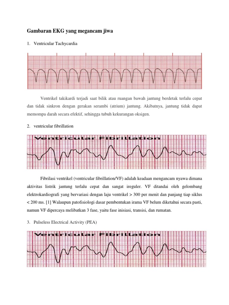 Gambaran EKG Yang Megancam Jiwa | PDF