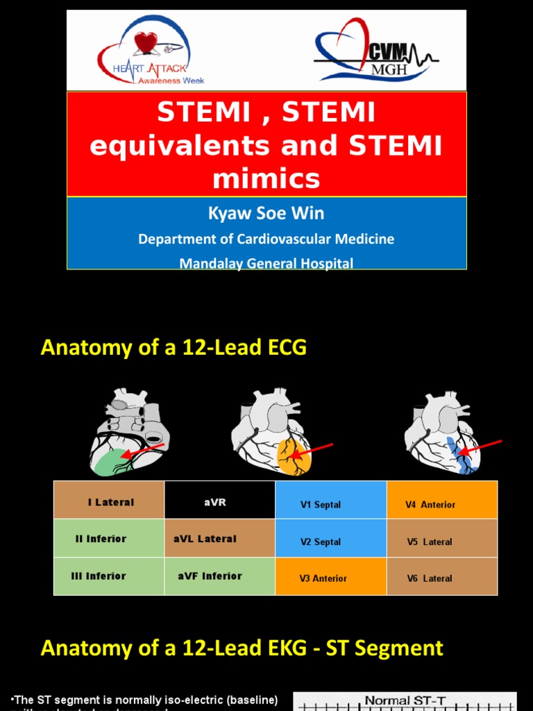 Stemi, Stemi Equivalents and STEMI Mimics: Kyaw Soe Win | PDF ...