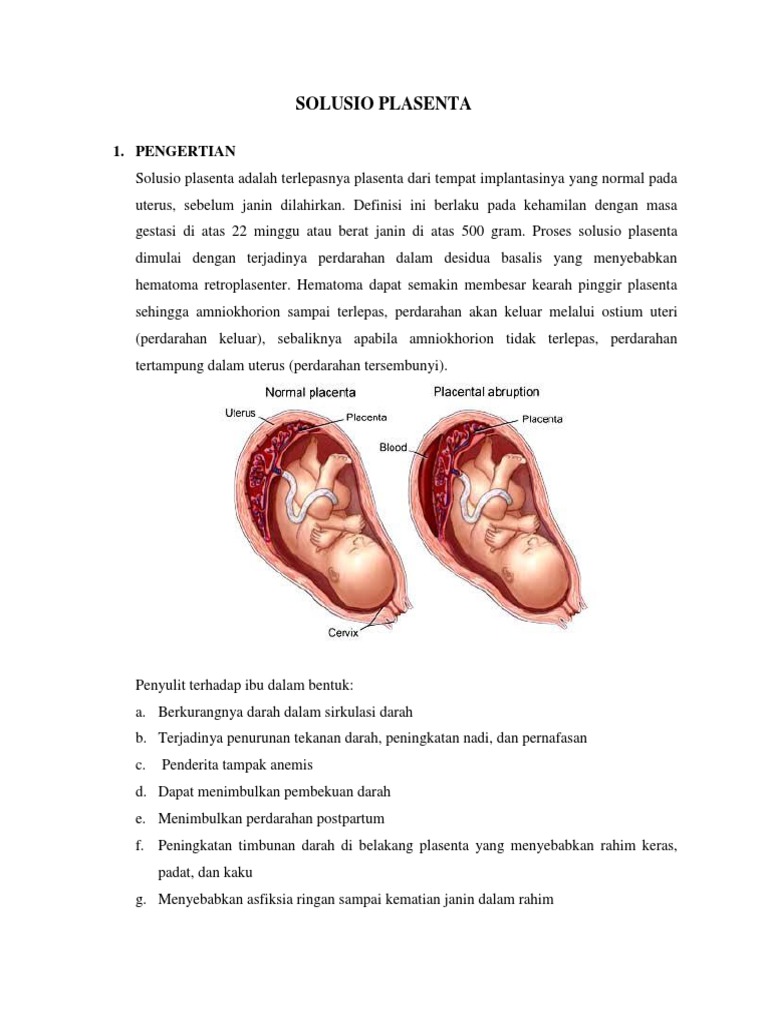 Solusio Plasenta | PDF