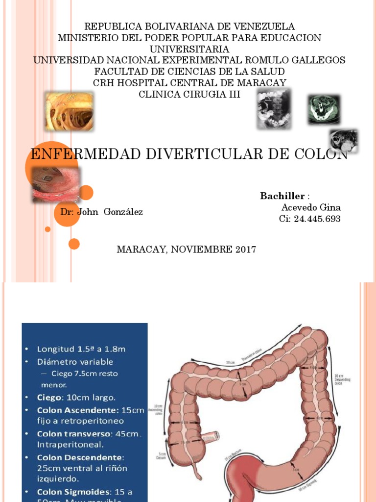 Enfermedad Diverticular | PDF | Rtt | Enfermedades digestivas
