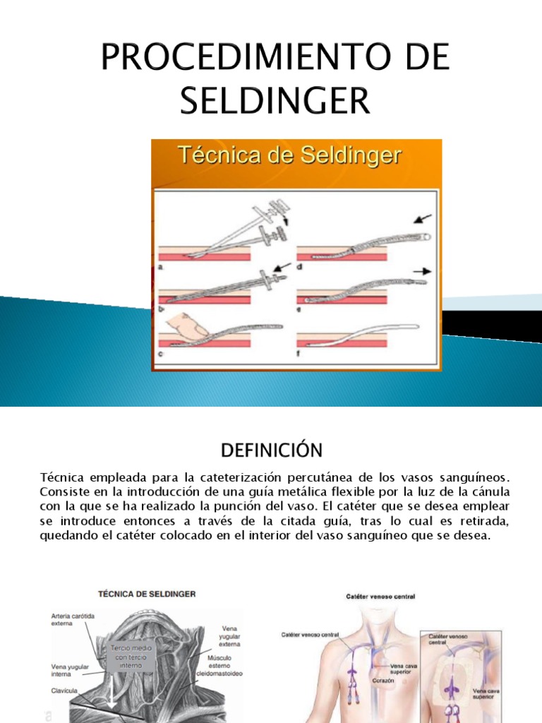 Procedimiento de Seldinger | PDF | Hemodiálisis | Tratamientos médicos