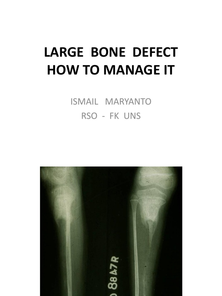 Large Bone Defect. DR Ismail | PDF | Diseases And Disorders | Skeletal ...