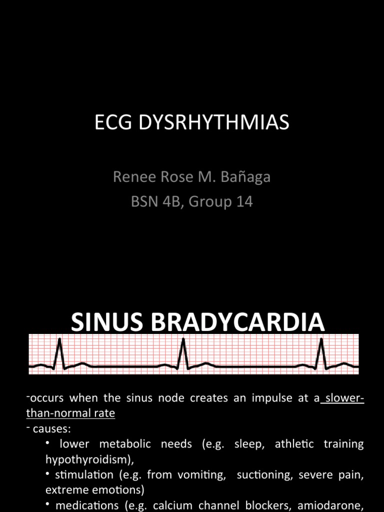Ecg Dysrhythmias: Renee Rose M. Bañaga BSN 4B, Group 14 | PDF | Cardiovascular Physiology ...