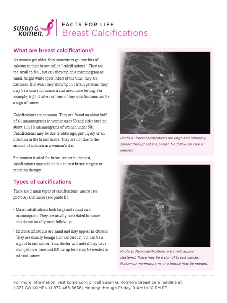 Breast Calcifications | PDF | Mammography | Breast Cancer