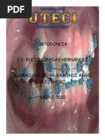 Aparato para Succion Digital | PDF | Ortodoncia | Enfermedades y trastornos