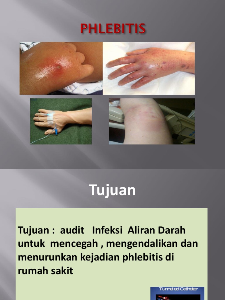 PHLEBITIS | PDF