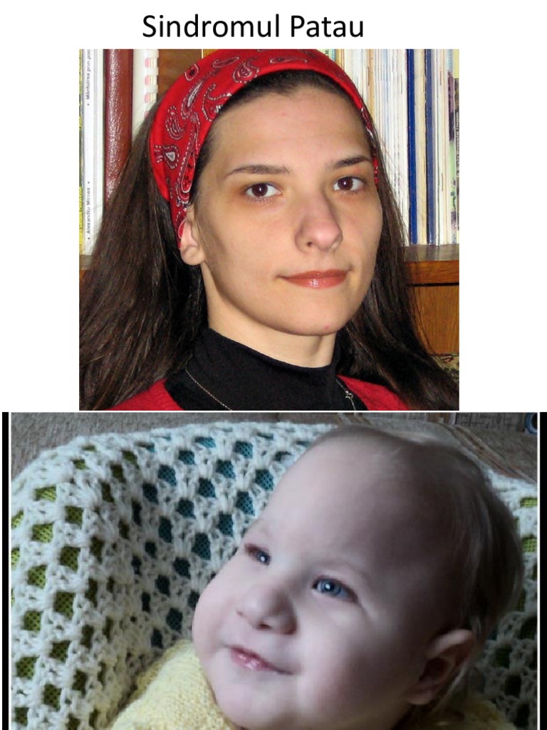 Sindromul Patau | PDF