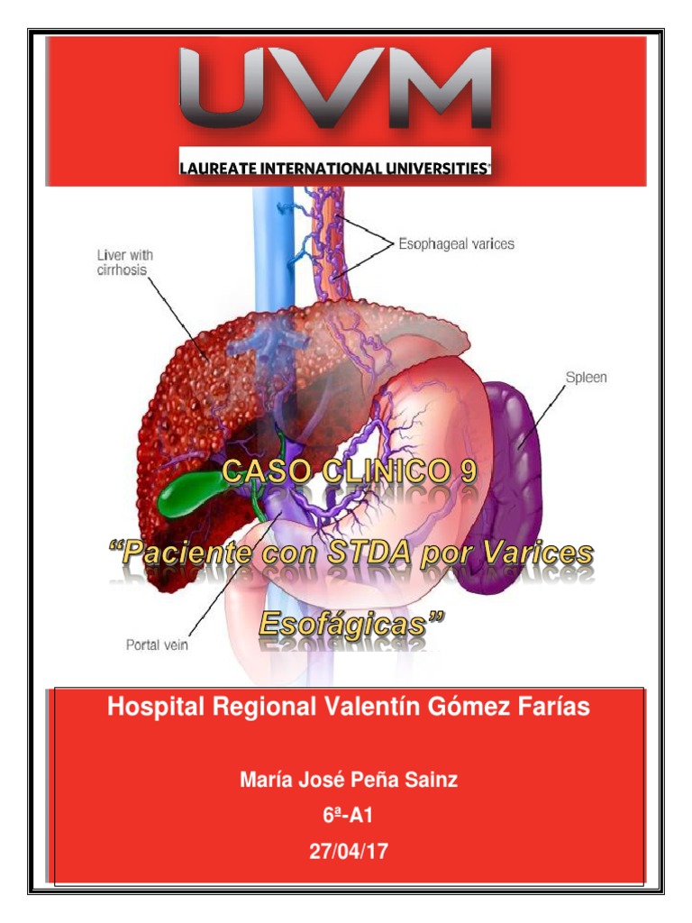 Anatomía De Las Varices Esofágicas