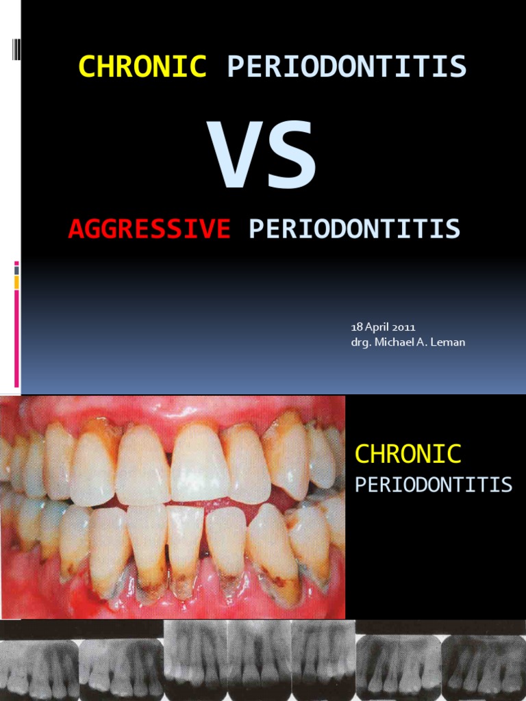 Severe Periodontitis