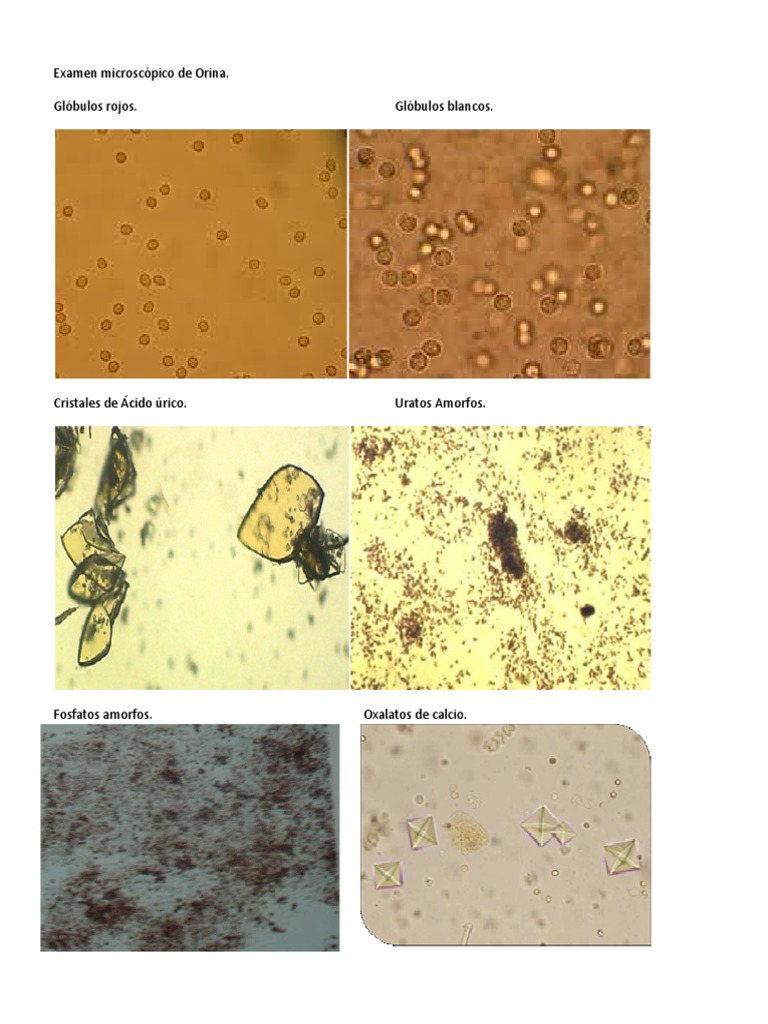 Examen Microscopico de Orina | PDF