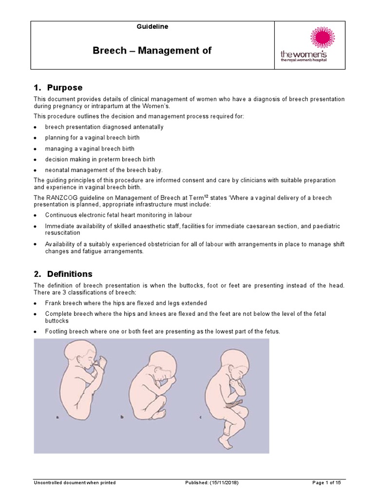 Breech - Management Of: 1. Purpose | PDF | Childbirth | Caesarean Section