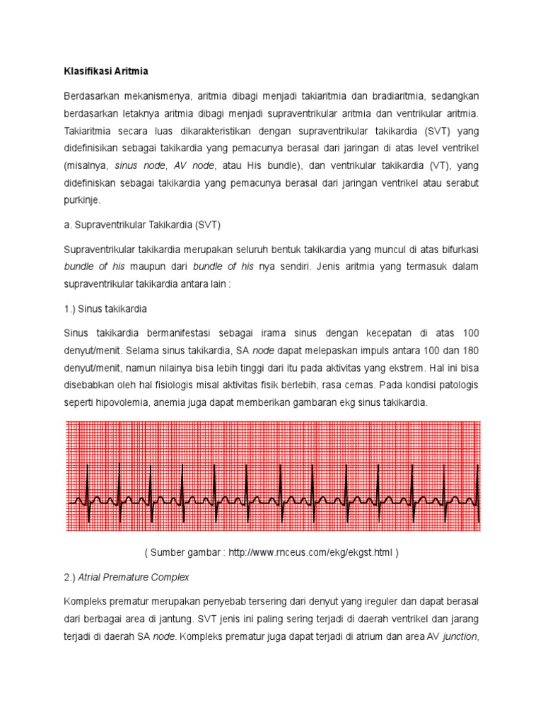Klasifikasi Aritmia Takikardi | PDF