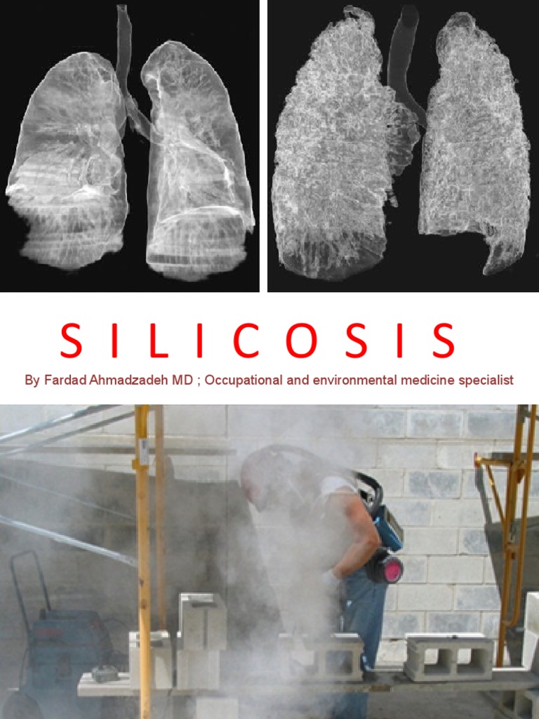 Silicosis: Understanding the Deadly Lung Disease | PDF | Medicine ...