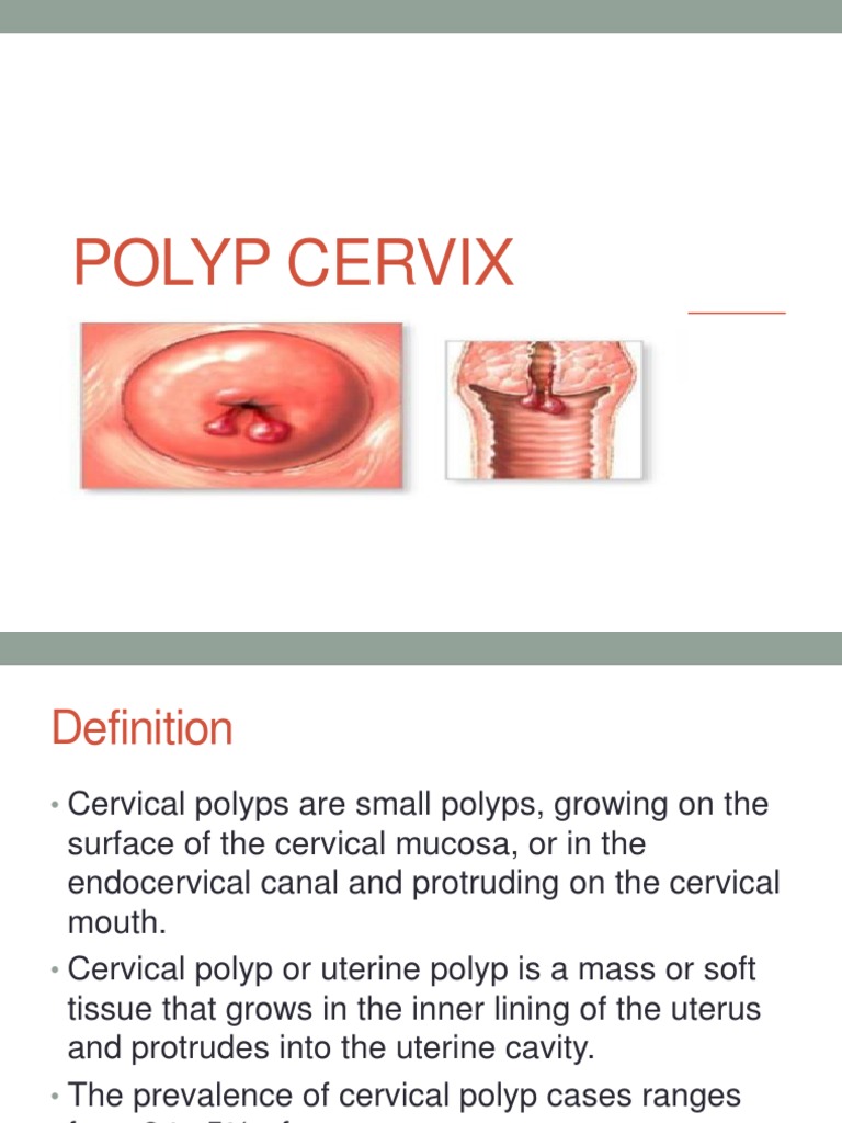 Polyp Cervix | Download Free PDF | Vagina | Uterus